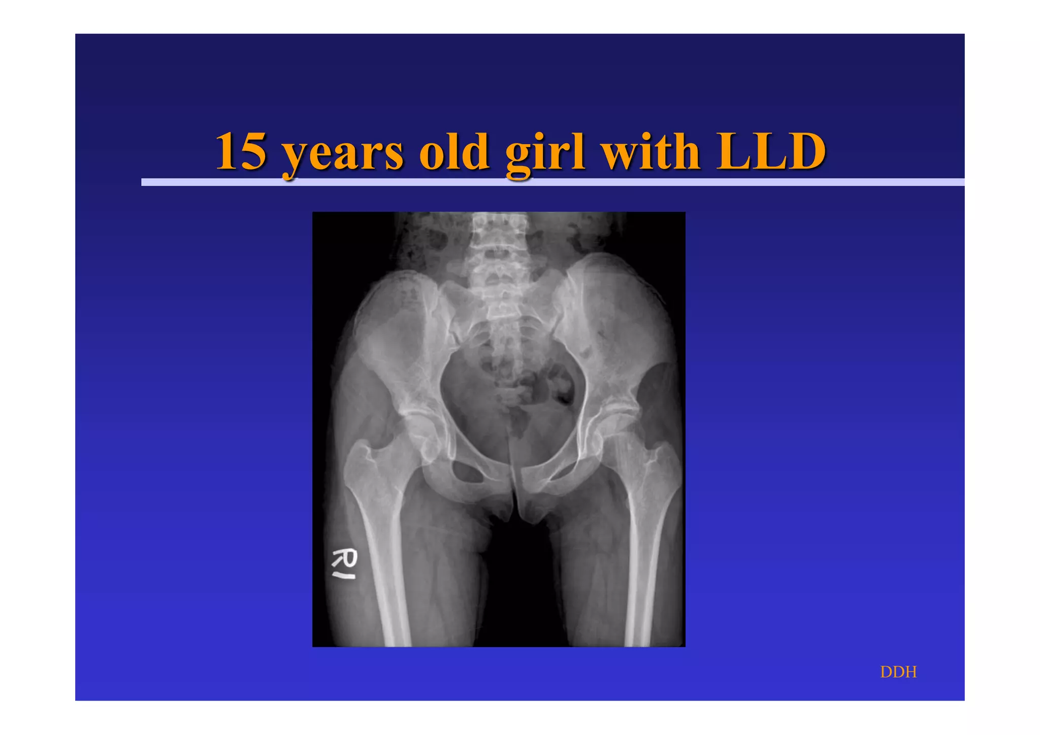 Pemberton Osteotomy in DDH.pdf