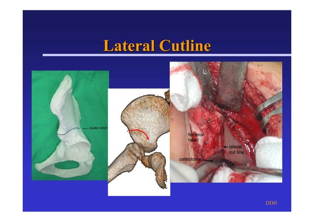 Pemberton Osteotomy in DDH.pdf