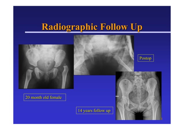 Pemberton Osteotomy in DDH.pdf