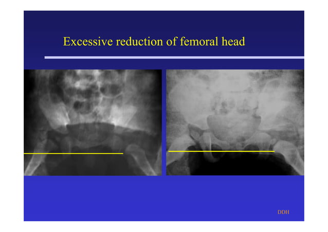 Pemberton Osteotomy in DDH.pdf