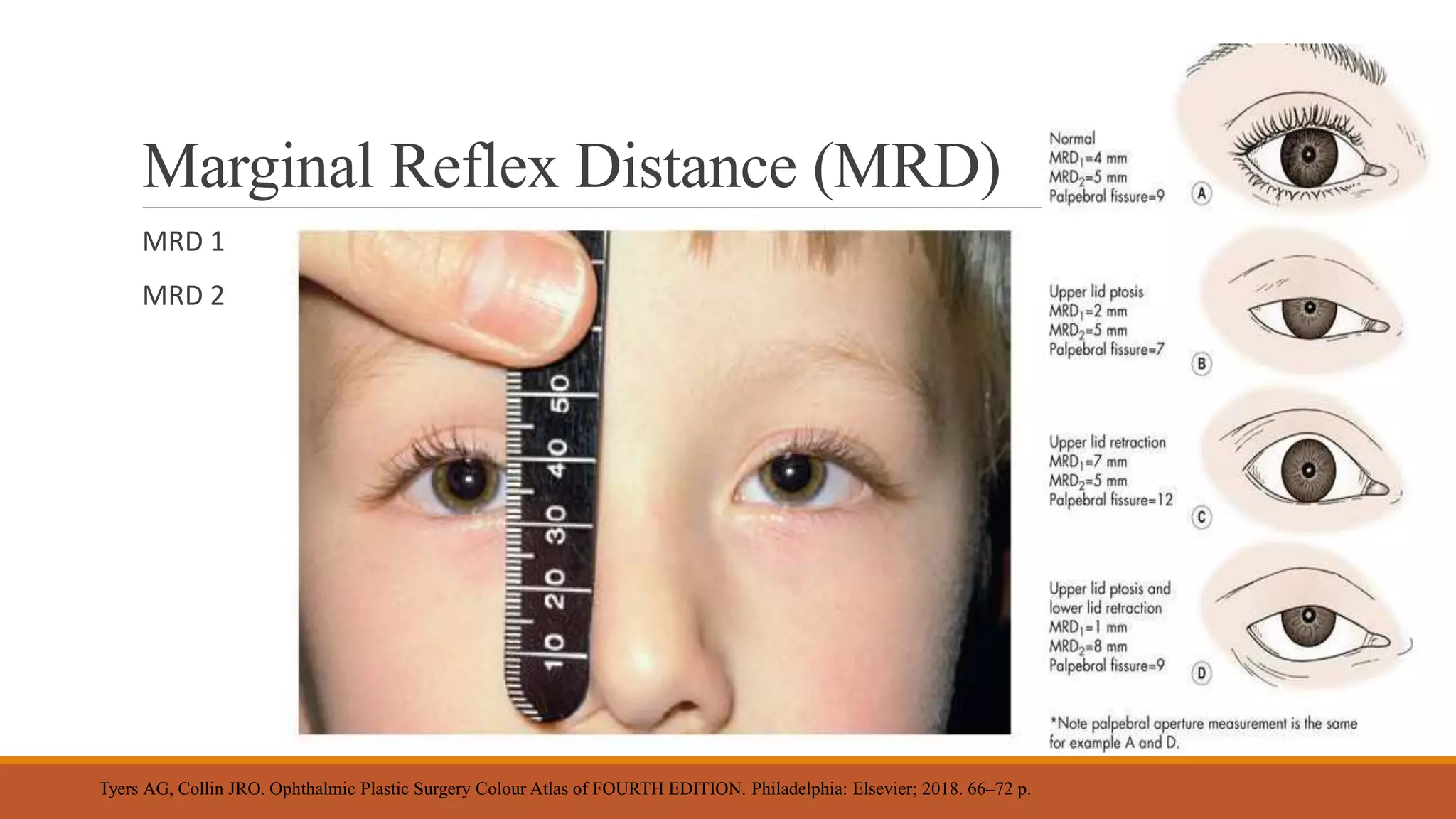 Pemeriksaan Palpebra.pptx