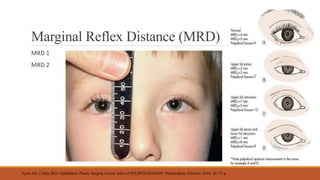 Pemeriksaan Palpebra.pptx