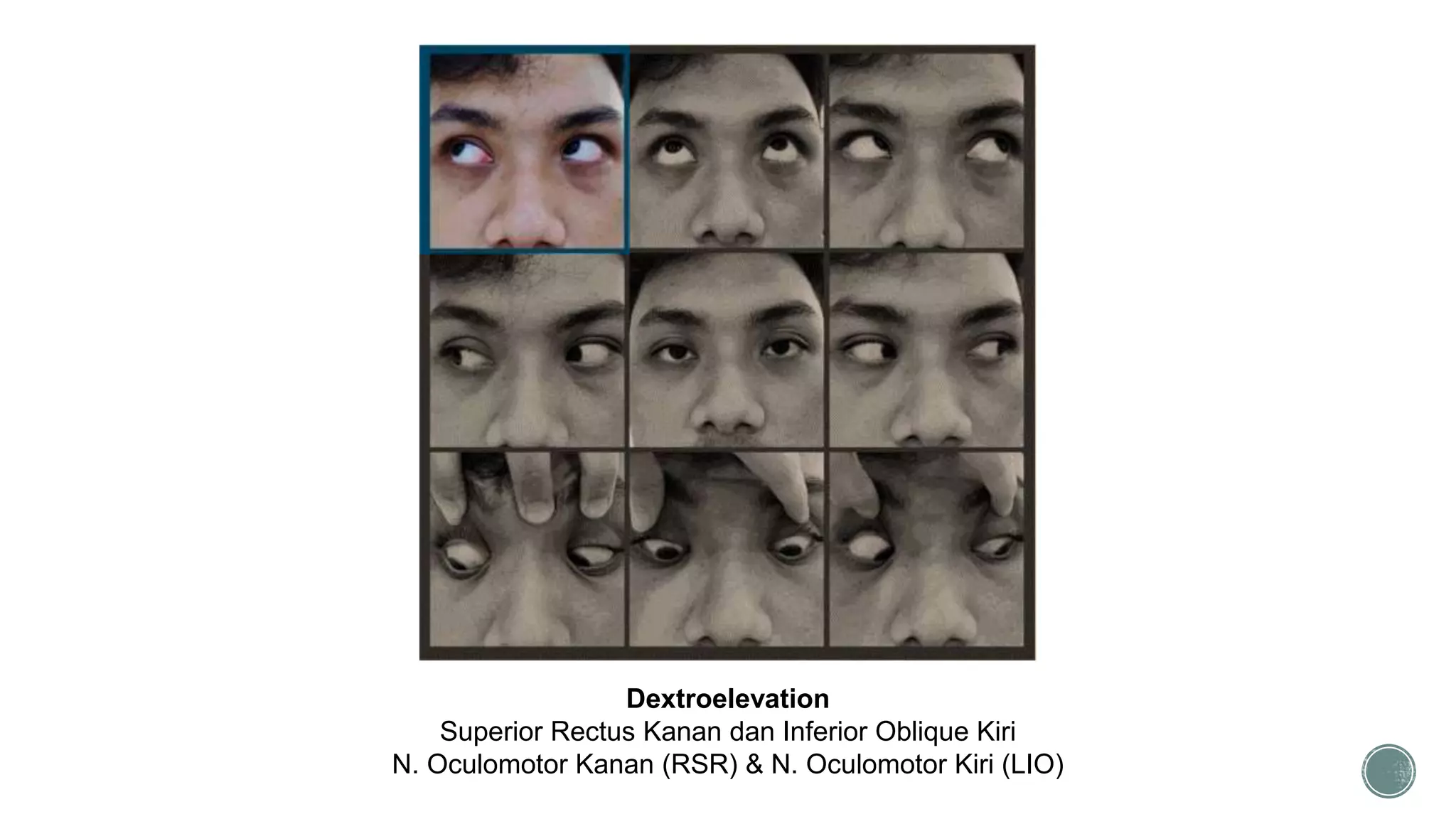 Pemeriksaan Pupil, Gerak Bola Mata, Saraf.pptx