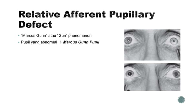 Pemeriksaan Pupil, Gerak Bola Mata, Saraf.pptx