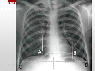 PEMERIKSAAN RADIOGRAFI DADA (CHEST RADIOGRAPHY) | PPT