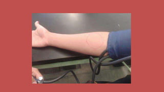 PEMERIKSAAN RUMPLE LEEDE.pptx