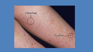 PEMERIKSAAN RUMPLE LEEDE.pptx