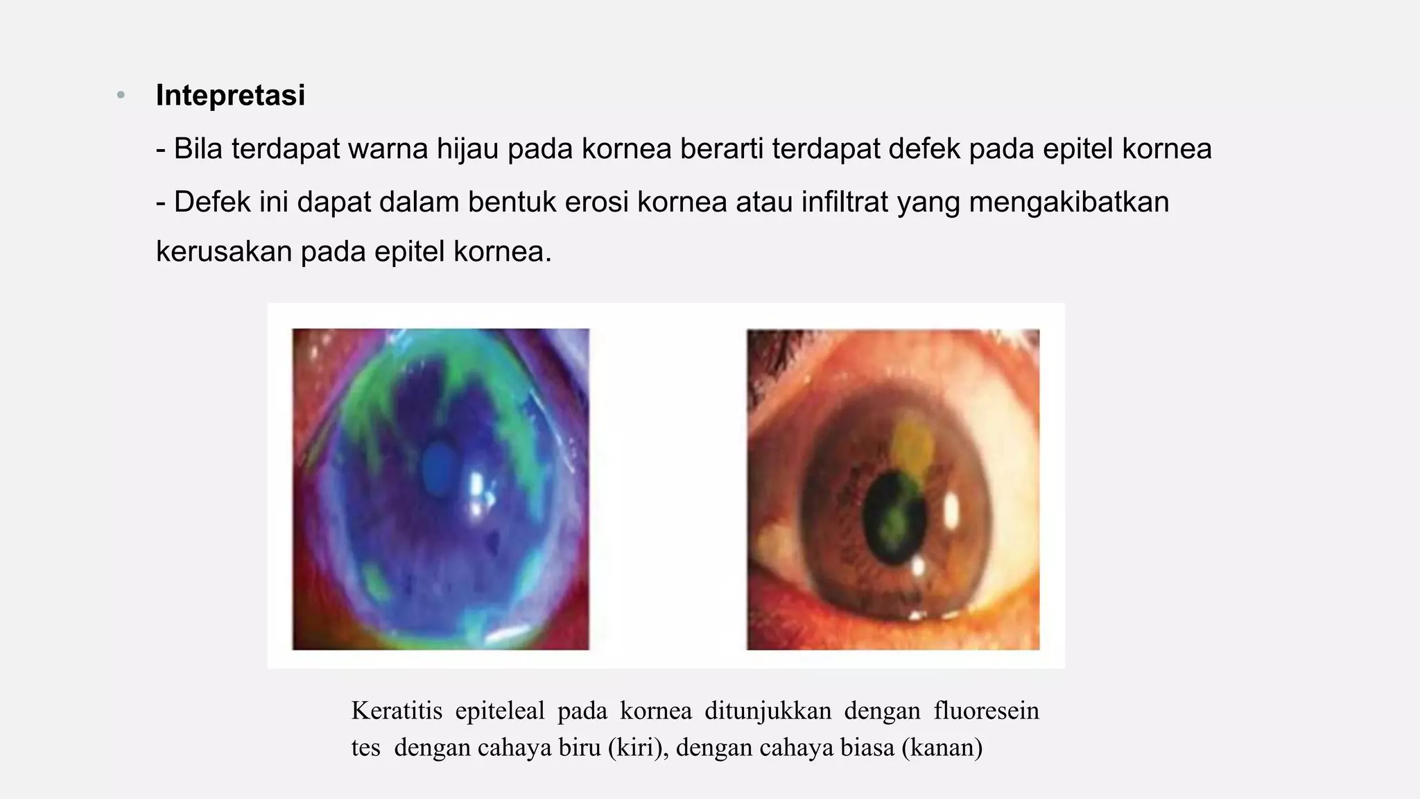 Pemeriksaan sensibilitas kornea dan inspeksi kornea fluoresein | PPTX