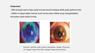 Pemeriksaan sensibilitas kornea dan inspeksi kornea fluoresein | PPTX