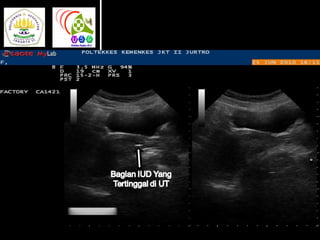 Pemeriksaan USG | PPT