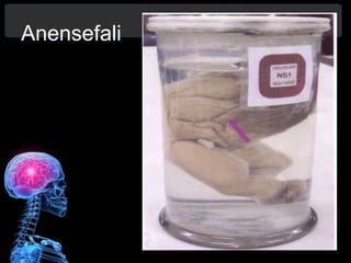 Anensefali (embriologi) | PPTX