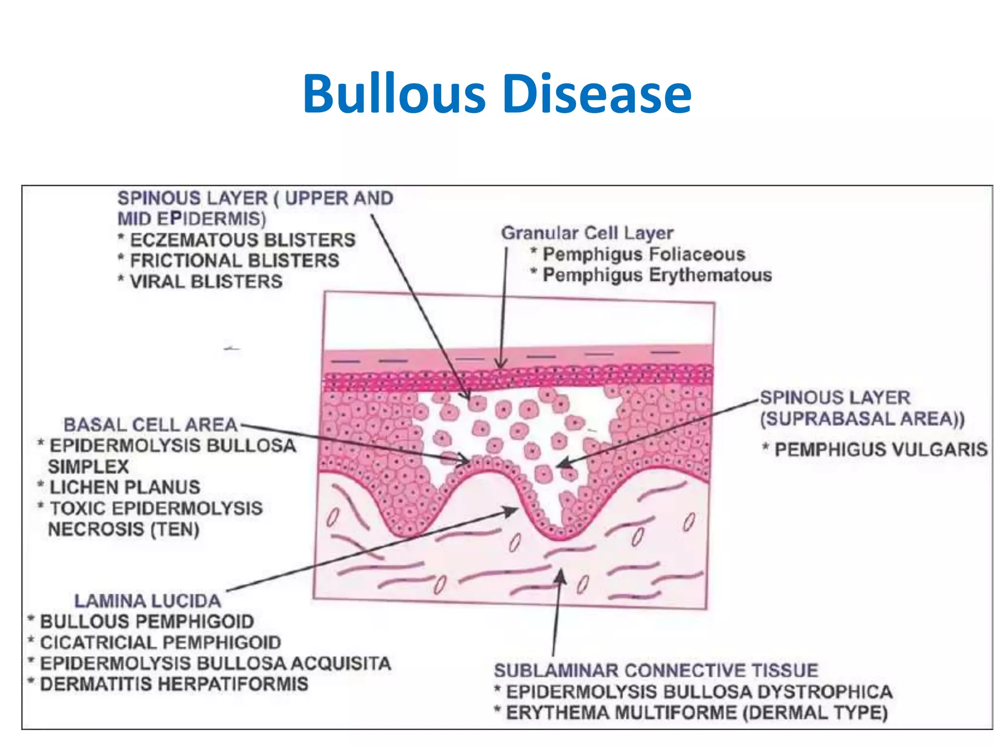 Pemphigus Disorders of skin | PPT | Free Download