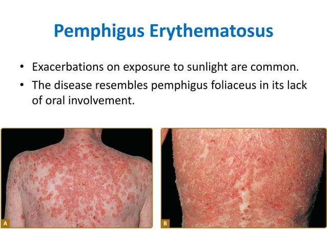 Pemphigus Disorders of skin | PPTX