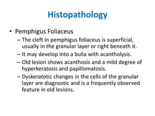 Pemphigus Foliaceus Histology