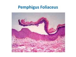 Pemphigus Foliaceus Histology