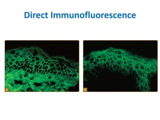 Pemphigus Foliaceus Immunofluorescence
