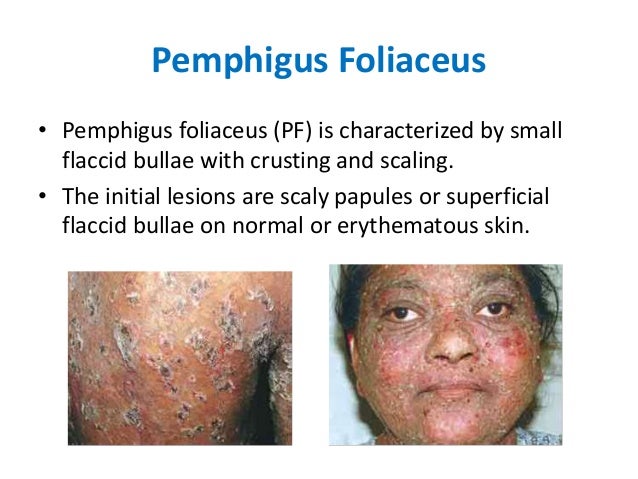 Pemphigus Disorders of skin