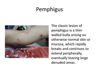 Pemphigus | PPTX
