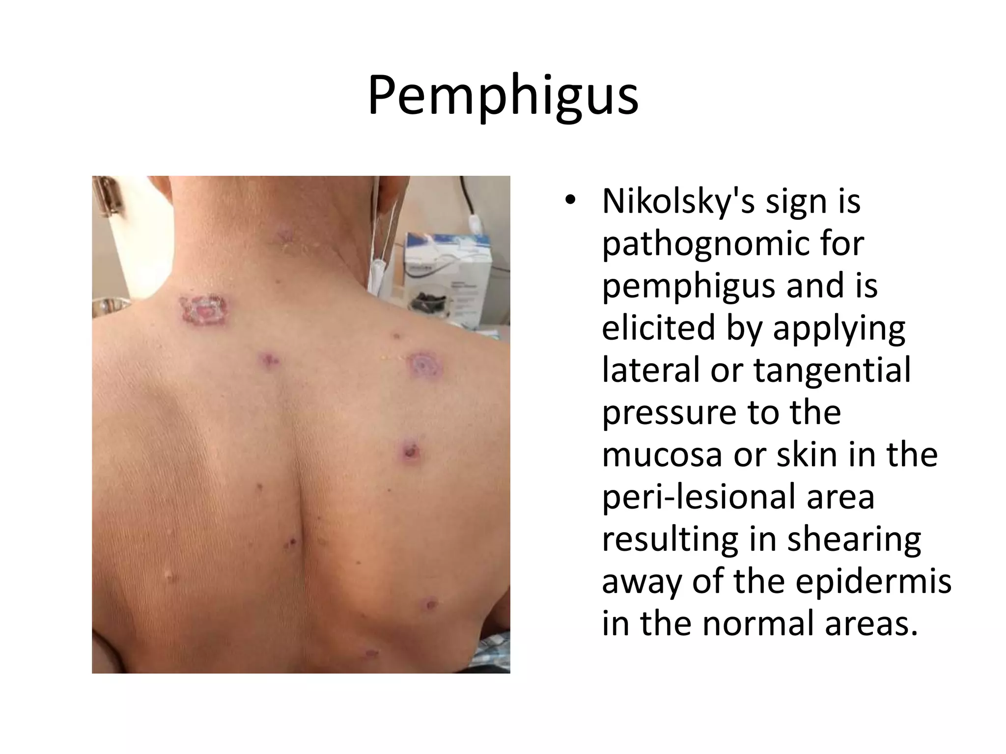 Pemphigus | PPTX