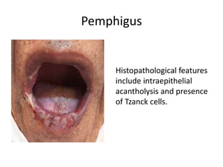Pemphigus | PPTX