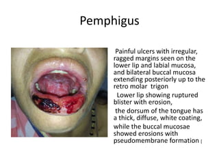 Pemphigus | PPTX