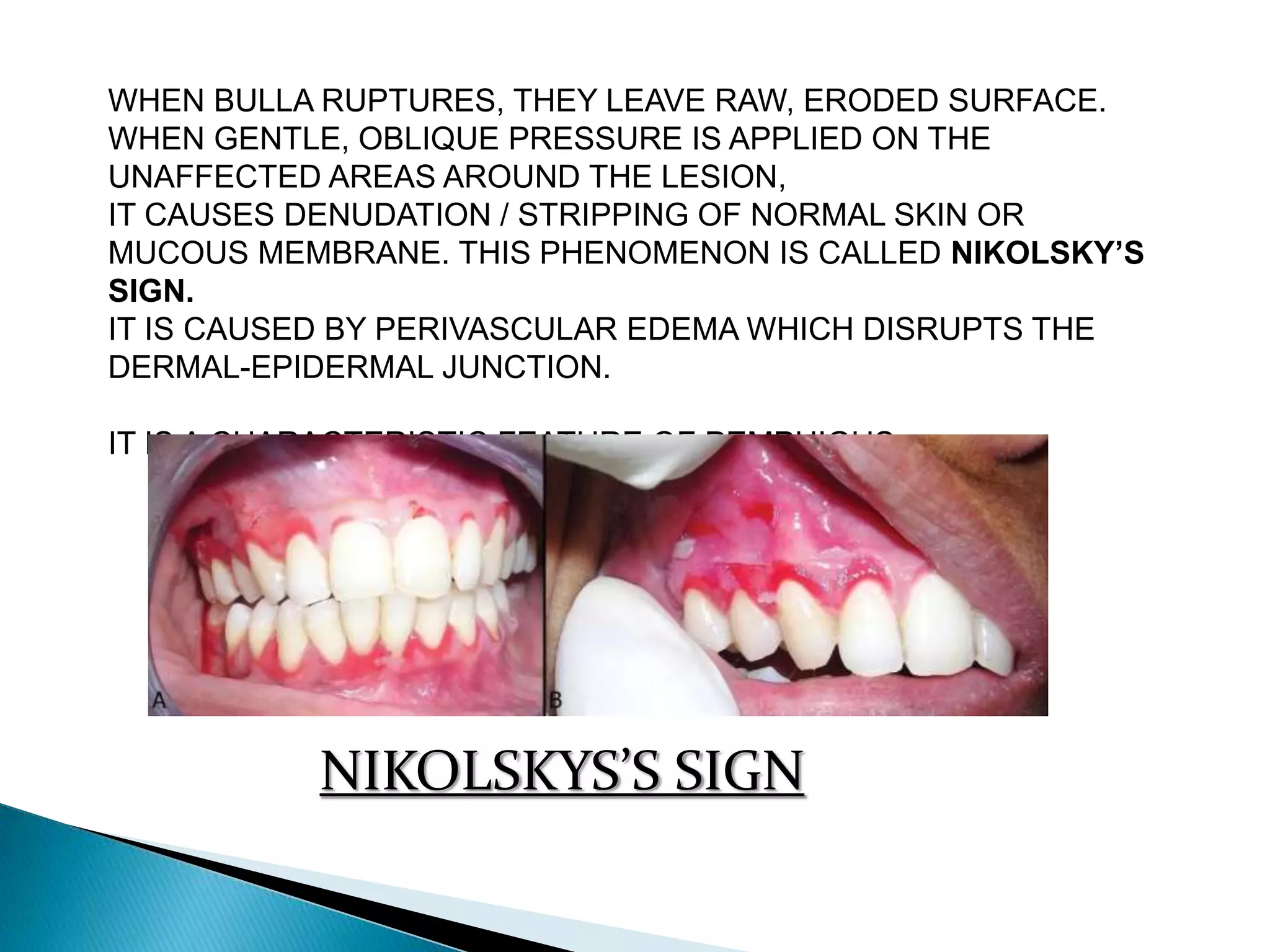 Pemphigus and Pemphigoid | PPTX