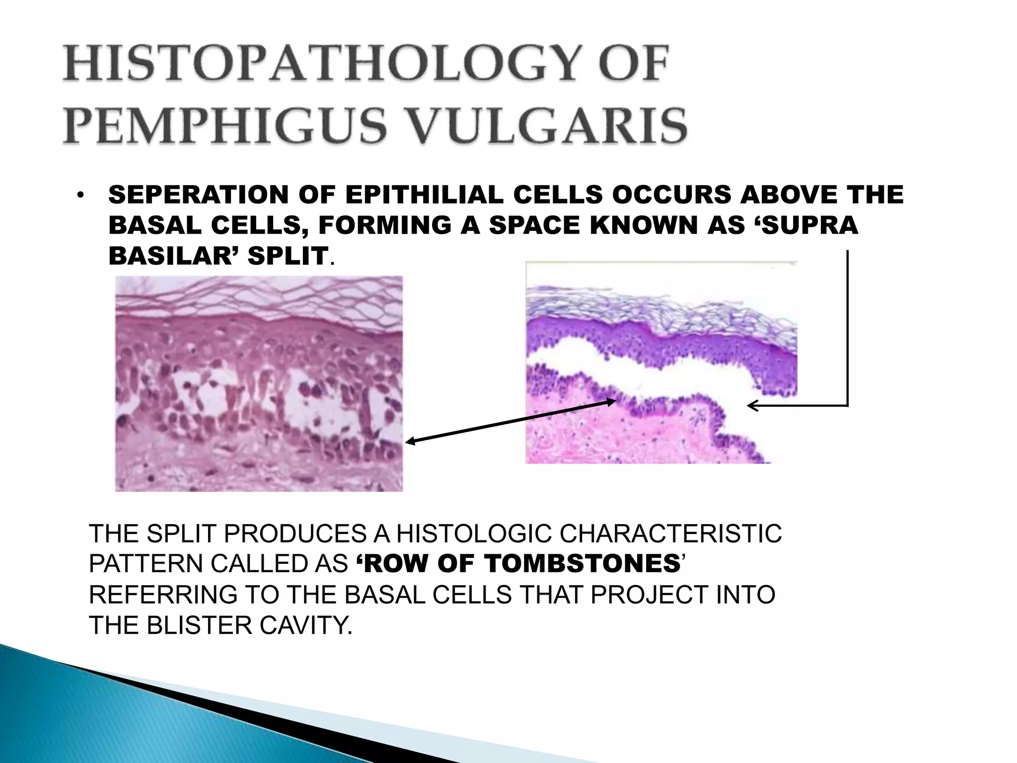 Pemphigus and Pemphigoid | PPTX
