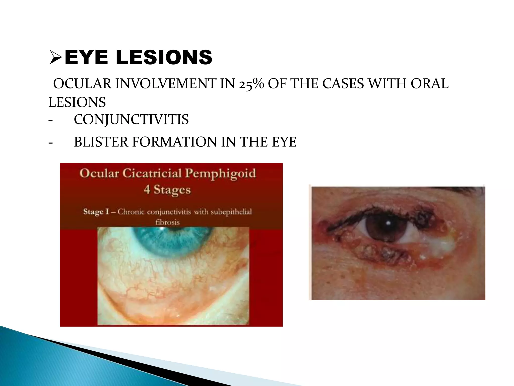 Pemphigus and Pemphigoid | PPTX