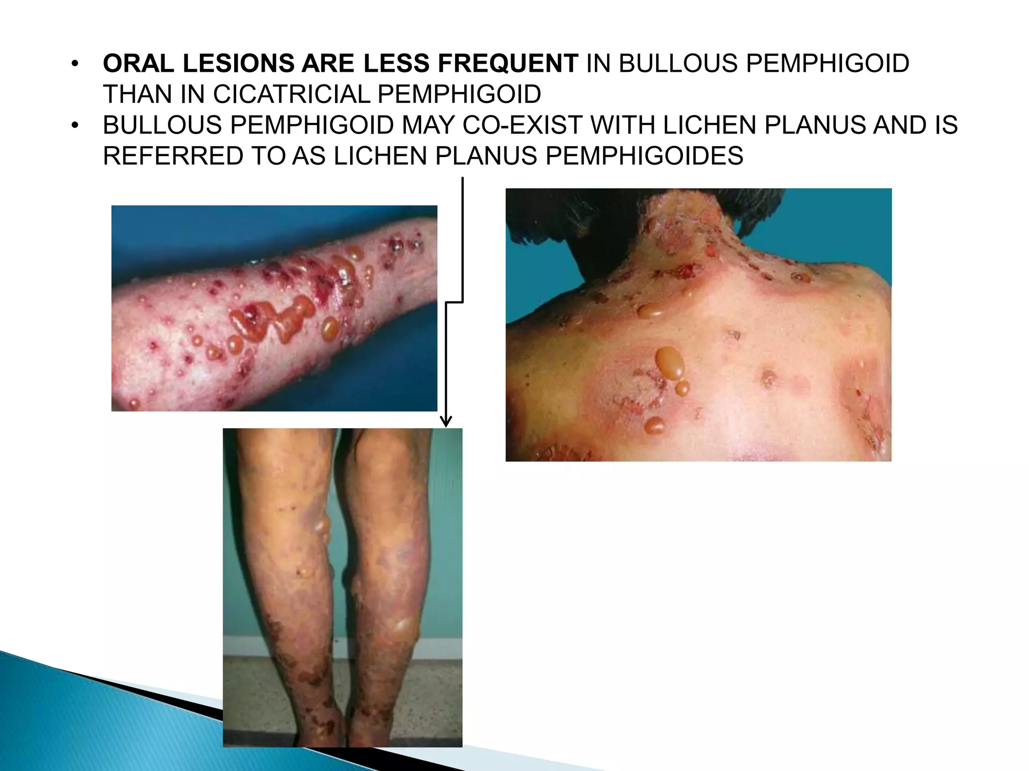 Pemphigus and Pemphigoid | PPTX