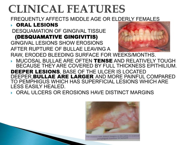 Pemphigus and Pemphigoid | PPTX | Skin and Dermatology | Diseases and ...
