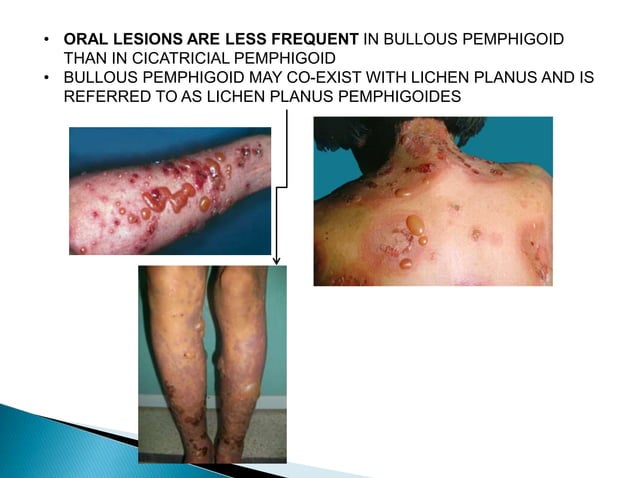 Pemphigus and Pemphigoid | PPTX | Skin and Dermatology | Diseases and ...