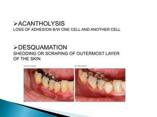 Pemphigus and Pemphigoid | PPTX