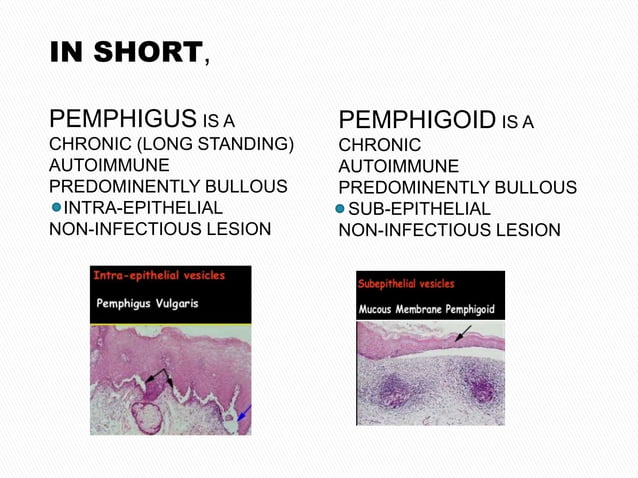 Pemphigus and Pemphigoid | PPTX | Skin and Dermatology | Diseases and ...