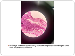 pemphigus.pptx