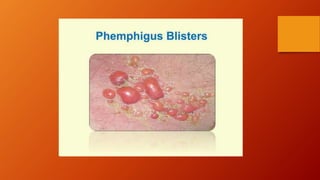 PEMPHIGUS.pptx Pemphigus is a blistering autoimmune disease that ...