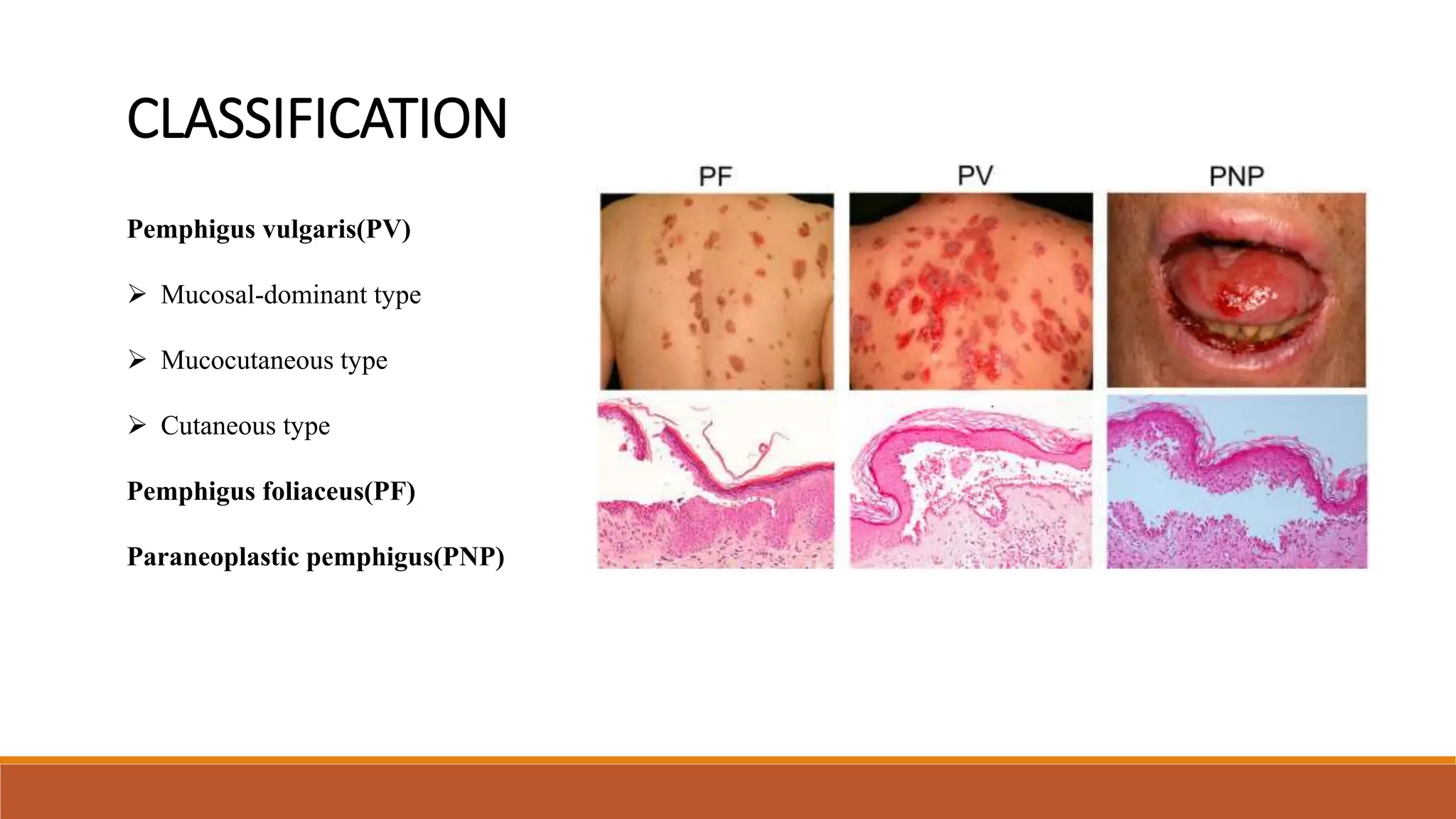 PEMPHIGUS, skin and mucous membrane disease | PPT