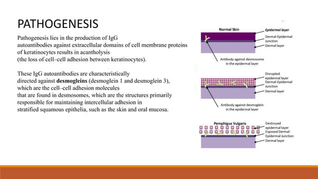 PEMPHIGUS, skin and mucous membrane disease | PPT