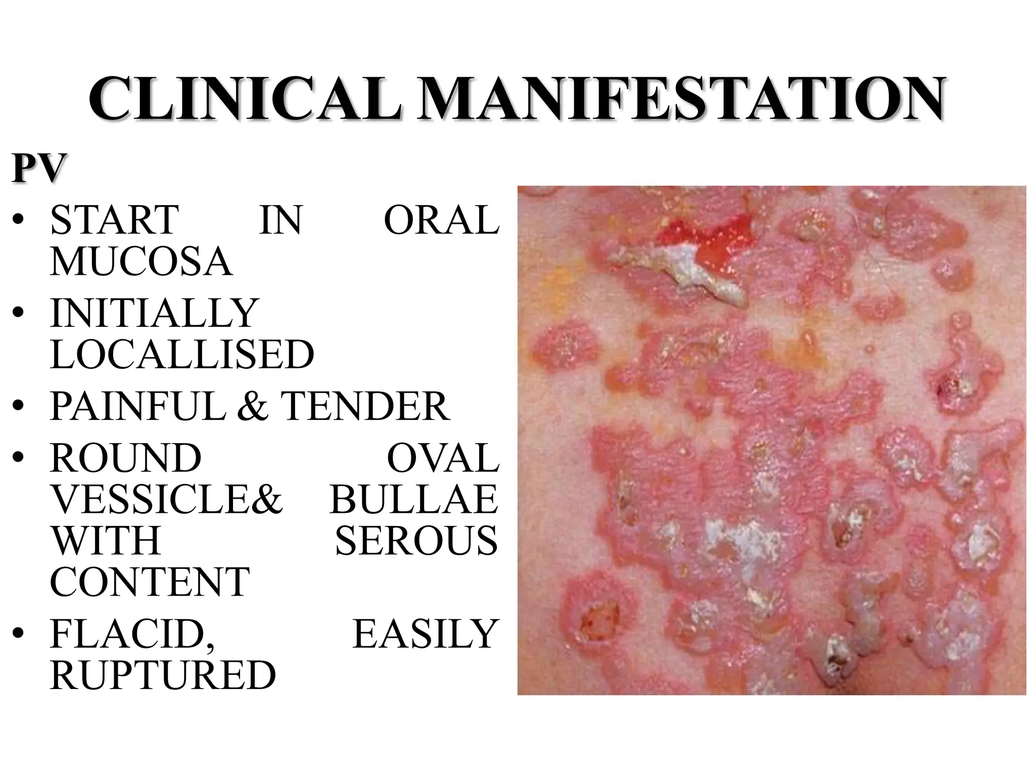 Pemphigus (Bullous Disease) | PPTX
