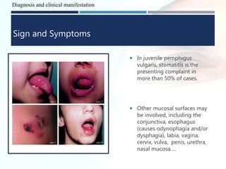 Pemphigus | PPTX