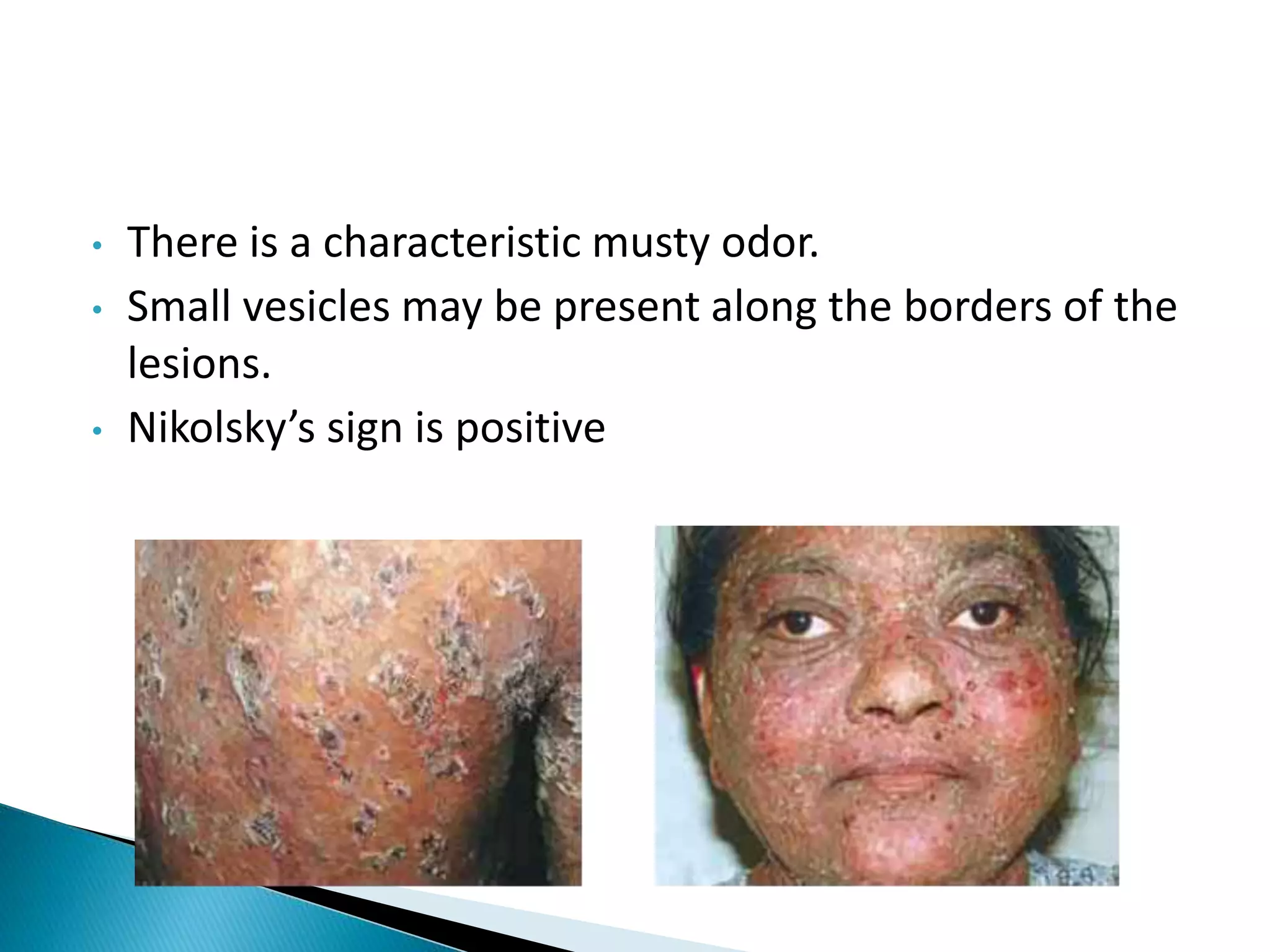 Pemphigus group of disorders | PPTX