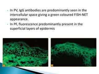 Pemphigus group of disorders | PPTX