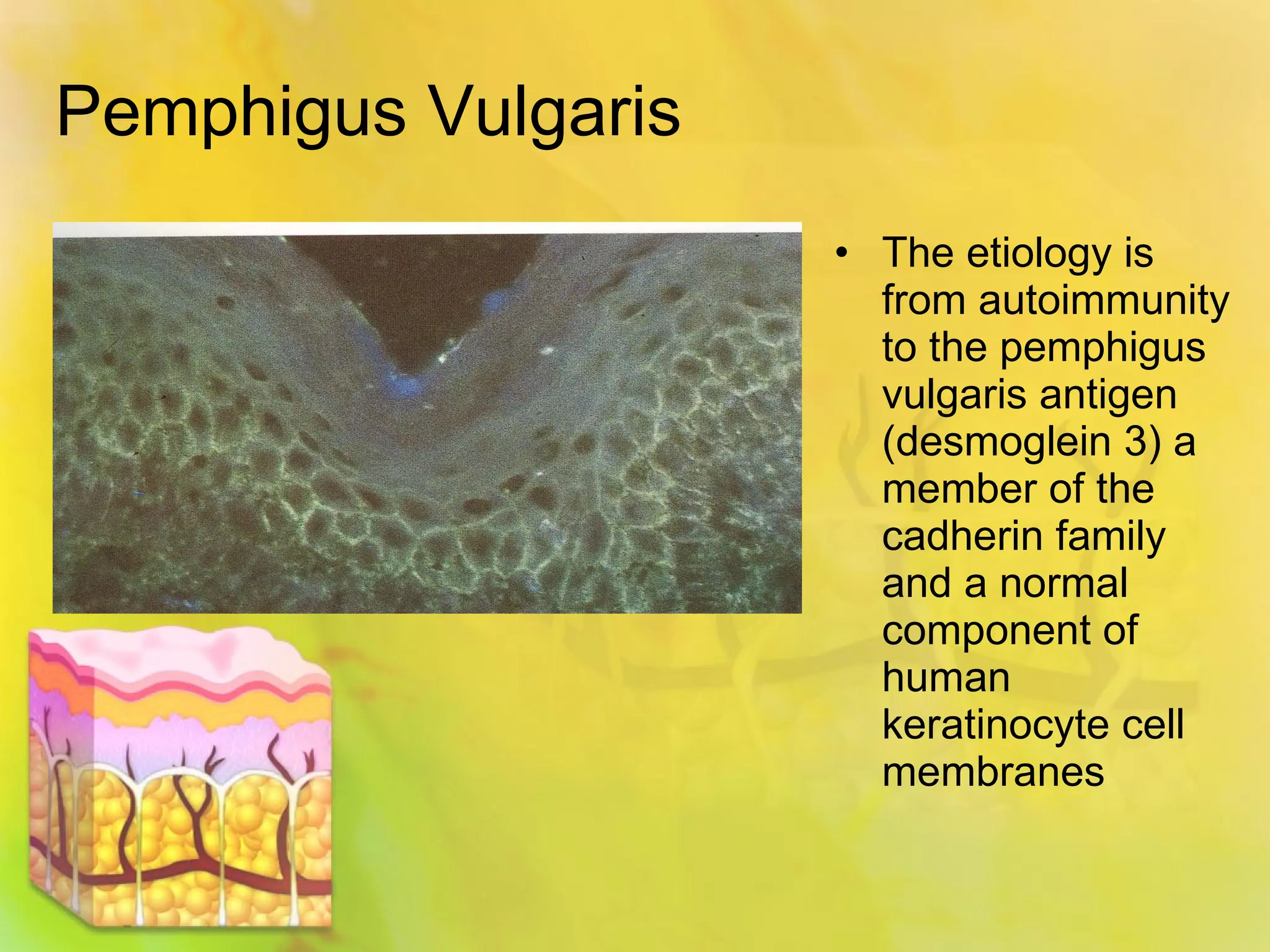 Pemphigus vulgaris | PPT