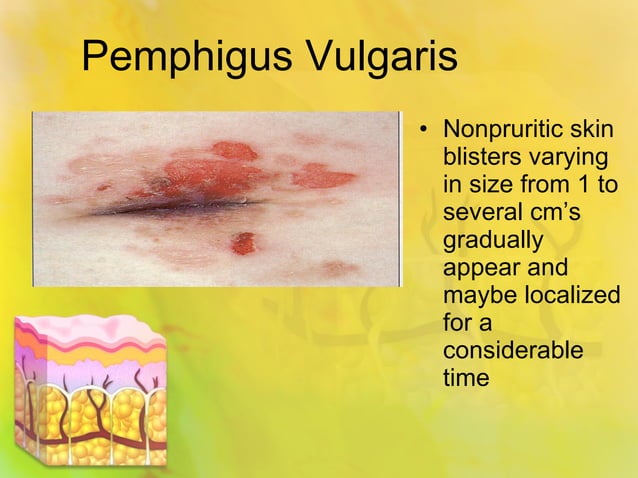 Pemphigus vulgaris | PPT