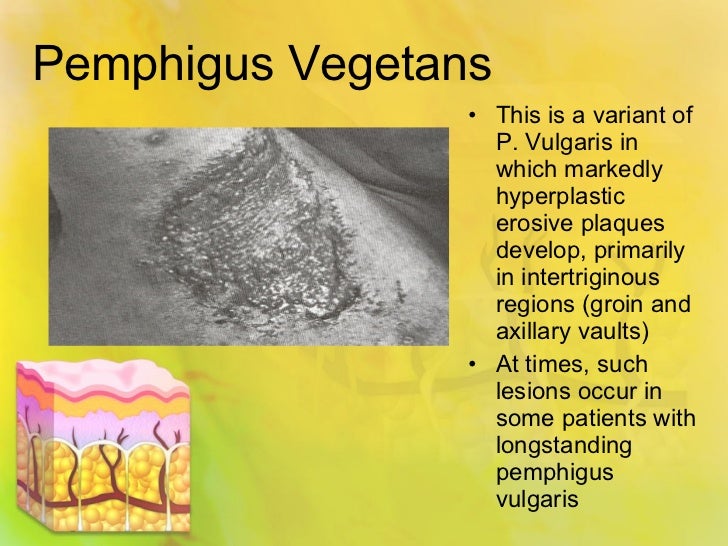 Pemphigus vulgaris