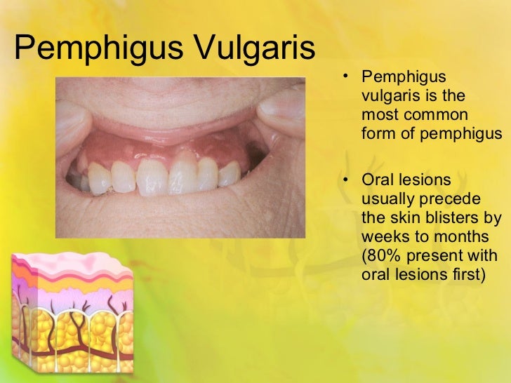 Pemphigus vulgaris