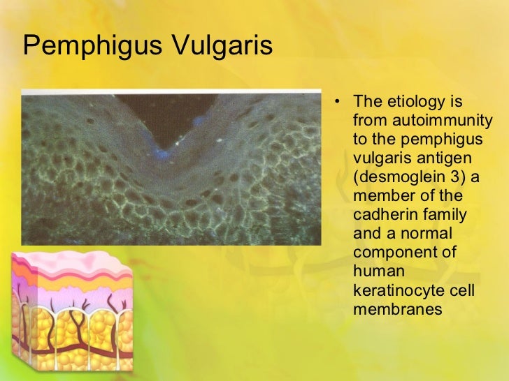 Pemphigus vulgaris
