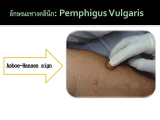 Pemphigus vulgaris (เพมฟิกัสวัลการิส) | PPT