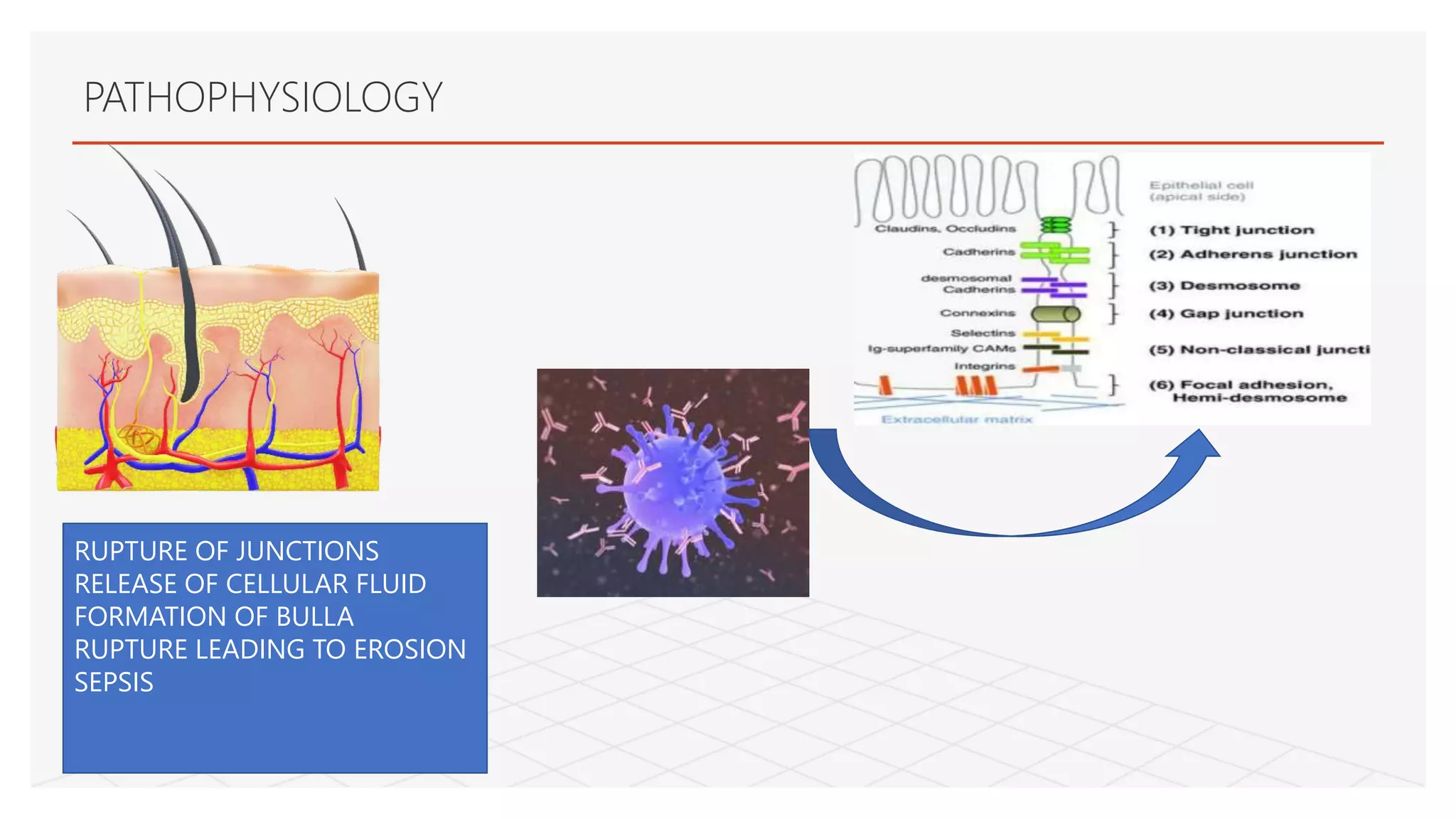 Pemphigus vulgaris | PPT