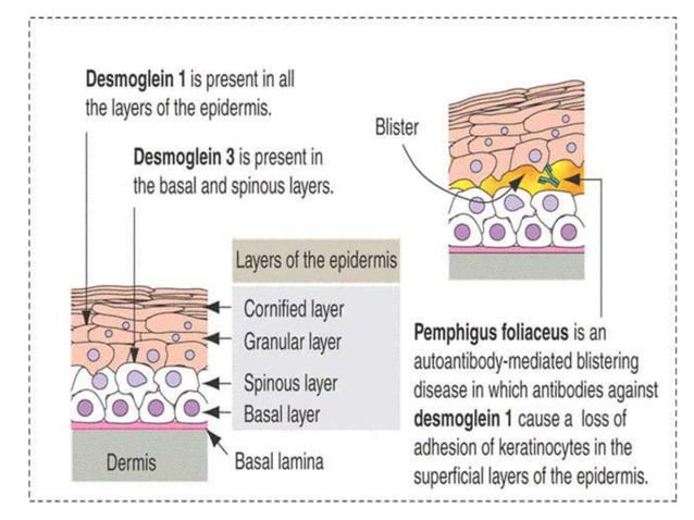 Pemphigus vulgaris presentation | PPTX | Skin and Dermatology ...