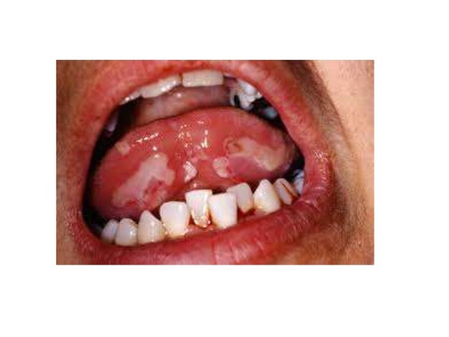 Pemphigus vulgaris presentation